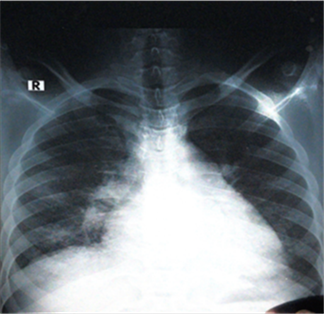 Peri-Annular and Septal Abscesses in Infectious Endocarditis. About 3 ...