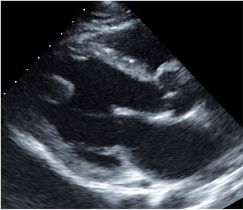 Modified Batista Procedure for Idiopathic Dilated Cardiomyopathy ...