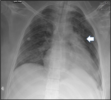 Venopulmonary ECMO Improved Hypoxemia and Supported the Right Ventricle ...
