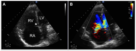 Venopulmonary ECMO Improved Hypoxemia and Supported the Right Ventricle ...