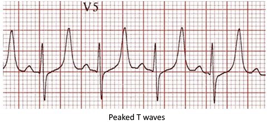 Electrocardiographic Manifestations of Endocrine and Metabolic Disorders