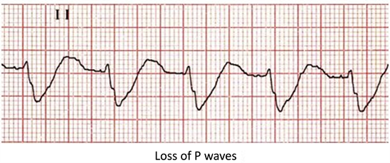 Electrocardiographic Manifestations of Endocrine and Metabolic Disorders