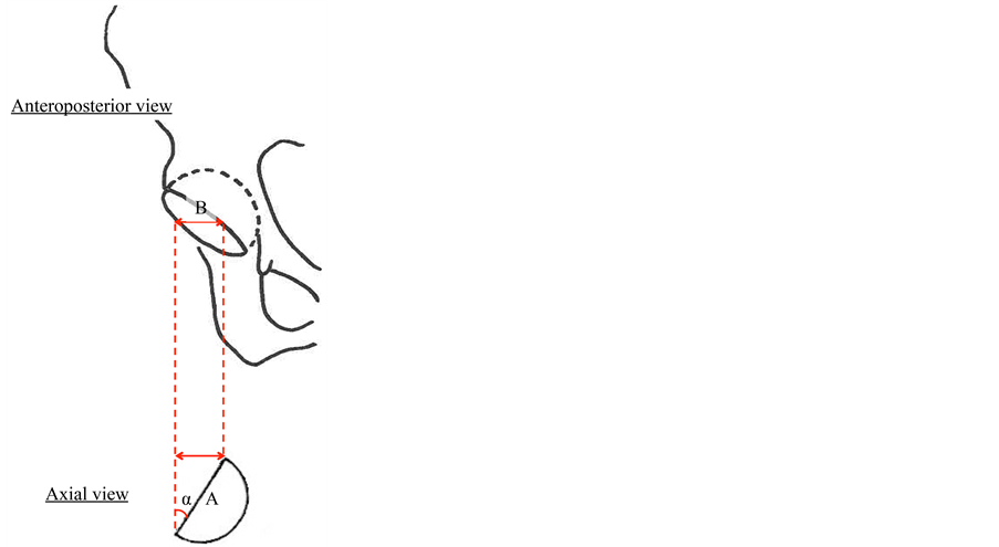 Anatomic Anteversion of the Acetabular Component Correlates with ...