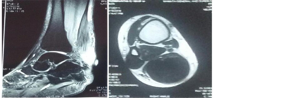Bilateral Achilles Tendon Xanthoma in an 18-Year-Old Patient
