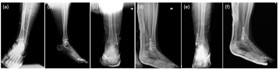 Neutralization versus Compression Plate on Lateral Malleolus Fracture ...
