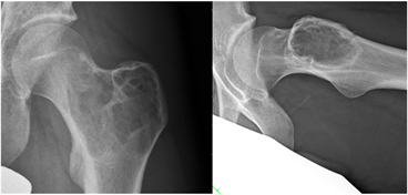 Treatment of Unicameral and Aneurysmal Bone Cysts by Minimally Invasive ...