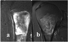 Treatment of Unicameral and Aneurysmal Bone Cysts by Minimally Invasive ...