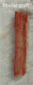 Endosteal Fibular Strut Graft with Proximal Humeral Locking Plate in ...