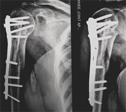 Endosteal Fibular Strut Graft with Proximal Humeral Locking Plate in ...