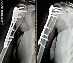 Endosteal Fibular Strut Graft with Proximal Humeral Locking Plate in ...