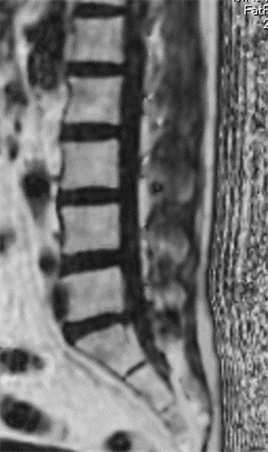 Quantitative Evaluation of Fat Composition in Lumbar Vertebral Body and ...