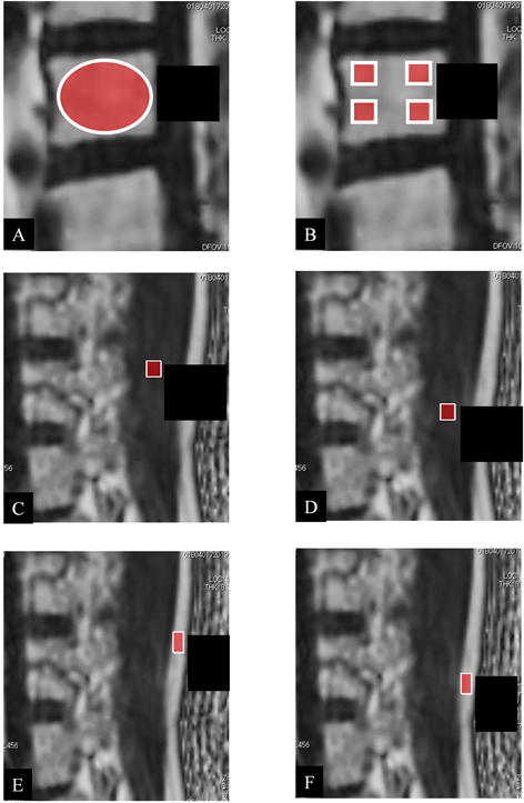 Quantitative Evaluation of Fat Composition in Lumbar Vertebral Body and ...