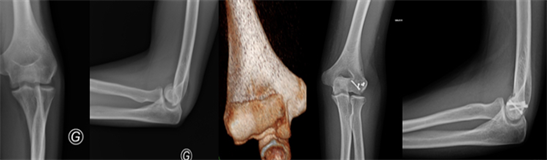 Management of Isolated Coronal Fractures of Distal Humeral Epiphysis by ...