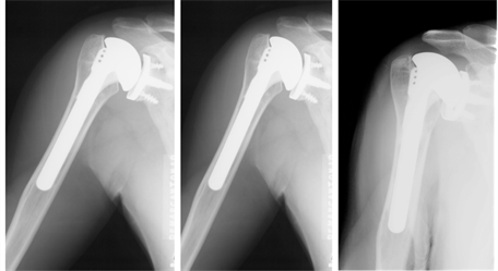 Buechel Pappas Resurfacing Shoulder Replacement: Evolution and over 40 ...