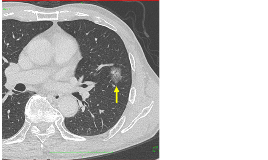 Unexpected Intraoperative Resecting of Common Trunk of Pulmonary Vein ...