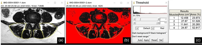 Quantification Threshold Pixel Technique of Magnetic Resonance Imaging ...