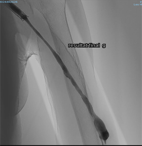 Cardiac Decompensation after Dilatation of an Arteriovenous Fistula ...