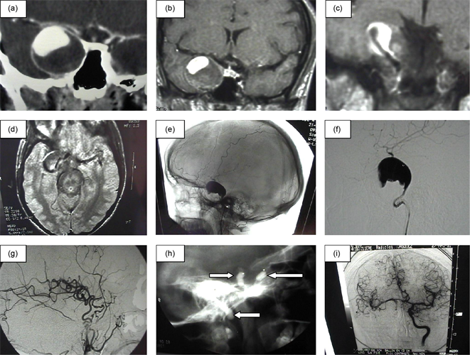 Superficial Temporal Artery to Middle Cerebral Artery Bypass and ...