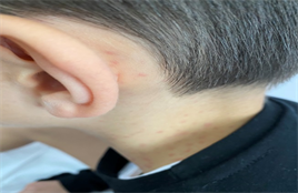 Muco-Cutaneous Changes Following COVID-19 in Children