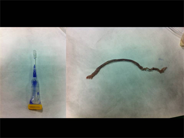 Endoscopic Management of Leaks Following Laparoscopic Sleeve ...