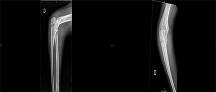 Surgical Treatment of Olecranon Fractures Using a Medartis Screw-Locked ...