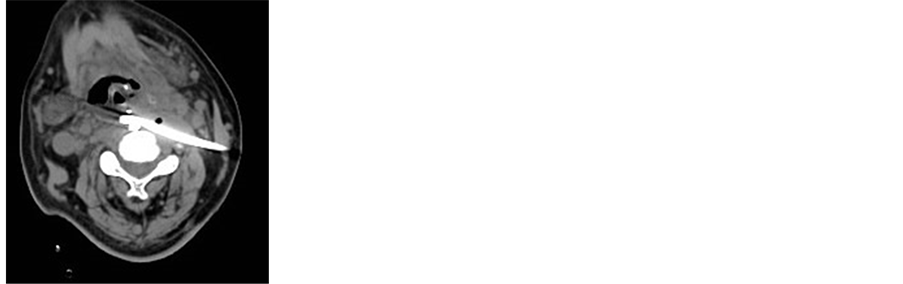 Effectiveness and Therapeutic Impact of CT-Guided Percutaneous Drainage ...
