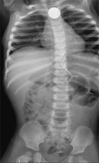 A Coin and Something Else: A Rare Case Report