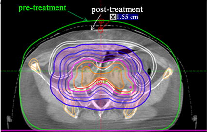 Dosimetric Evaluation of Body Contour Changes to Target Volumes and ...
