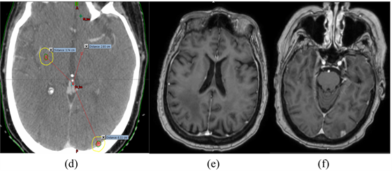 Distance to Isocenter Directly Affects Margin and Inappropriate Margin Increases the Risk of ...