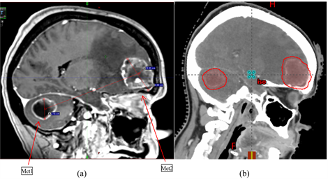 Distance to Isocenter Directly Affects Margin and Inappropriate Margin Increases the Risk of ...