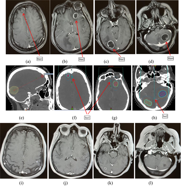 Distance to Isocenter Directly Affects Margin and Inappropriate Margin Increases the Risk of ...