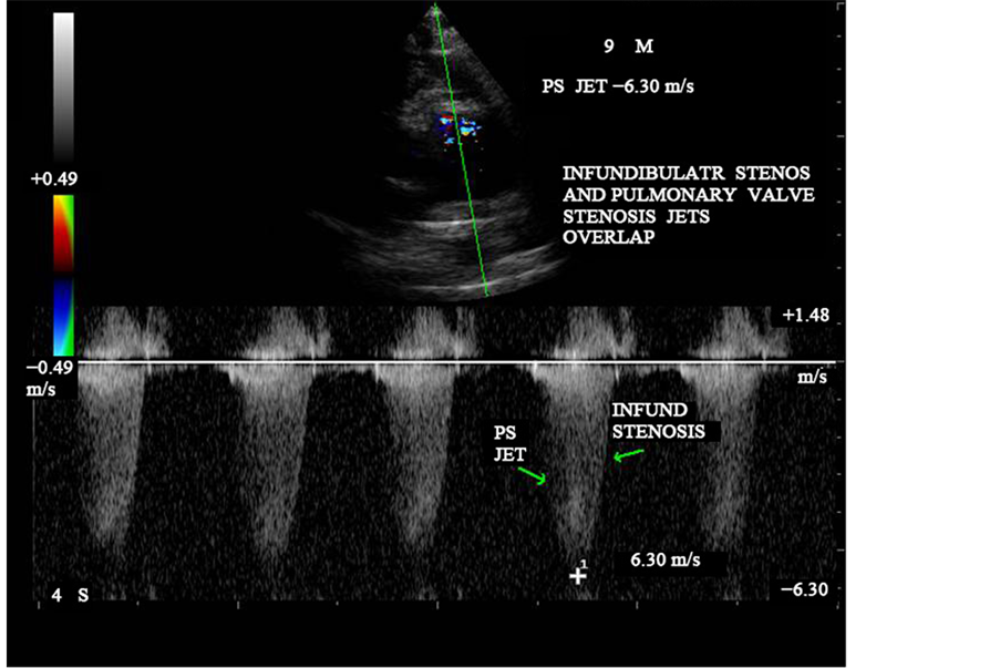 Costello Syndrome with Congenital Pulmonary Valve Stenosis and ...