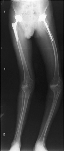 One-Stage Bilateral Total Hip Arthroplasty for Hemophilic Spontaneous ...