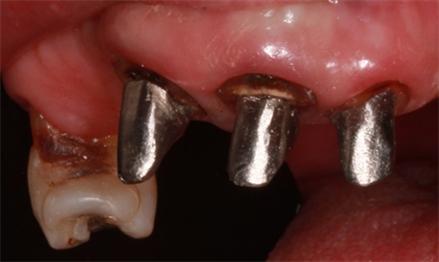 Use of Extra-Narrow-Diameter Implants in Reduced Alveolar Ridge: A Case ...