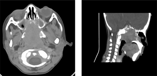 Pediatric Nasopharyngeal Rhabdomyosarcoma: About a Case and Review of ...