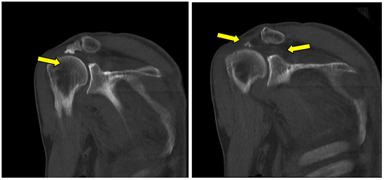 Analysis of CT and MRI in the Diagnosis of Shoulder Joint Injury