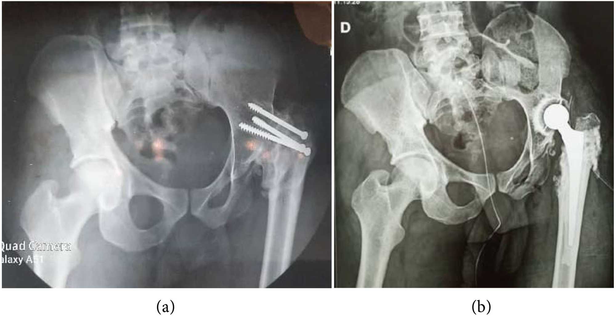 Primary Total Hip Arthroplasty on Complex Hips Conditions in a Low-Resource Setting