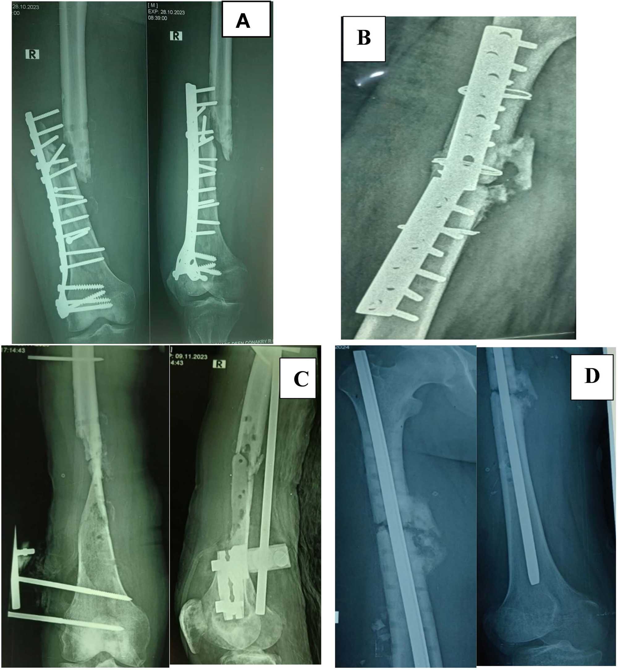 Mechanical Complications of Osteosynthesis: Frequency and Management at ...