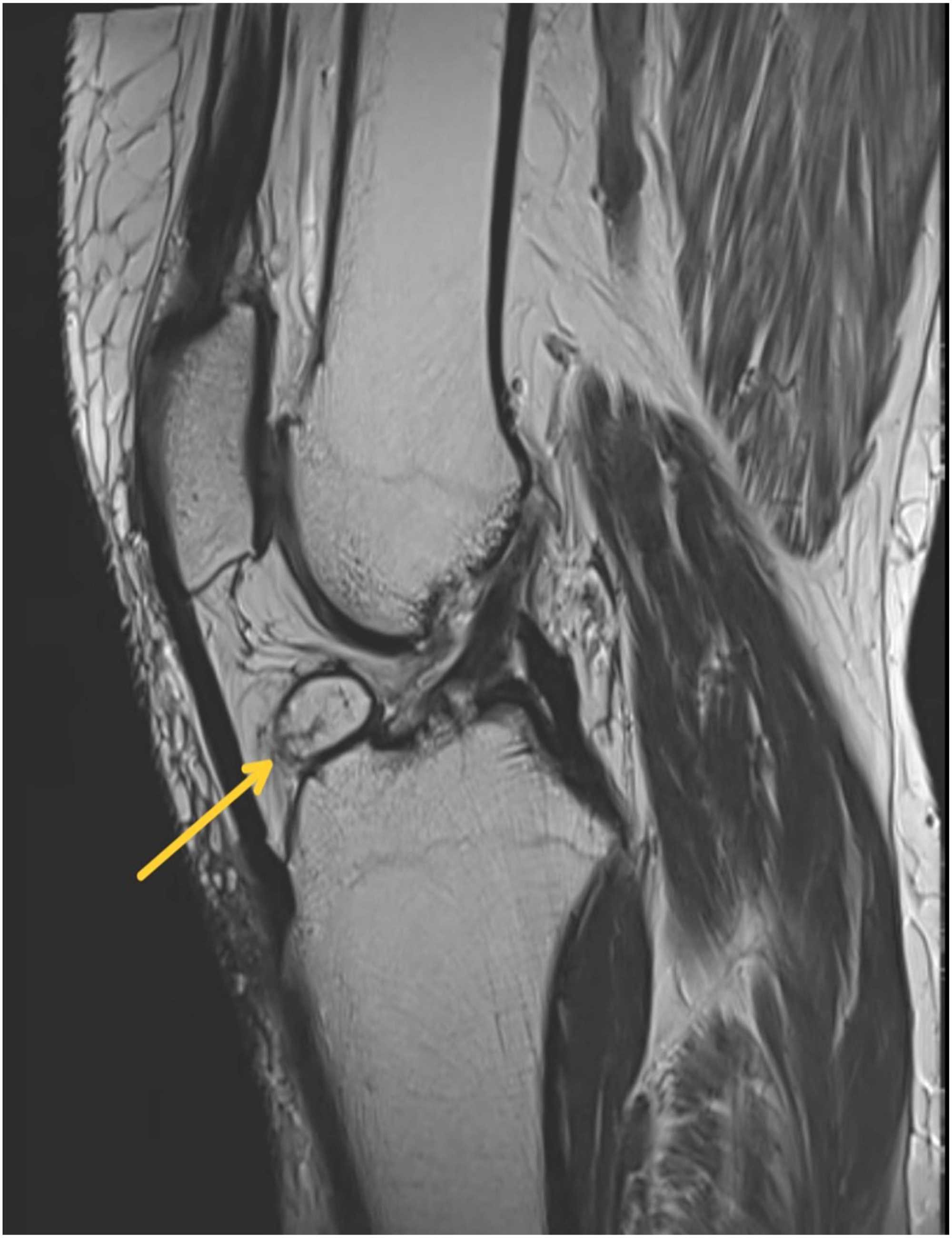 Loose Body in the Knee Joint: A Case Report
