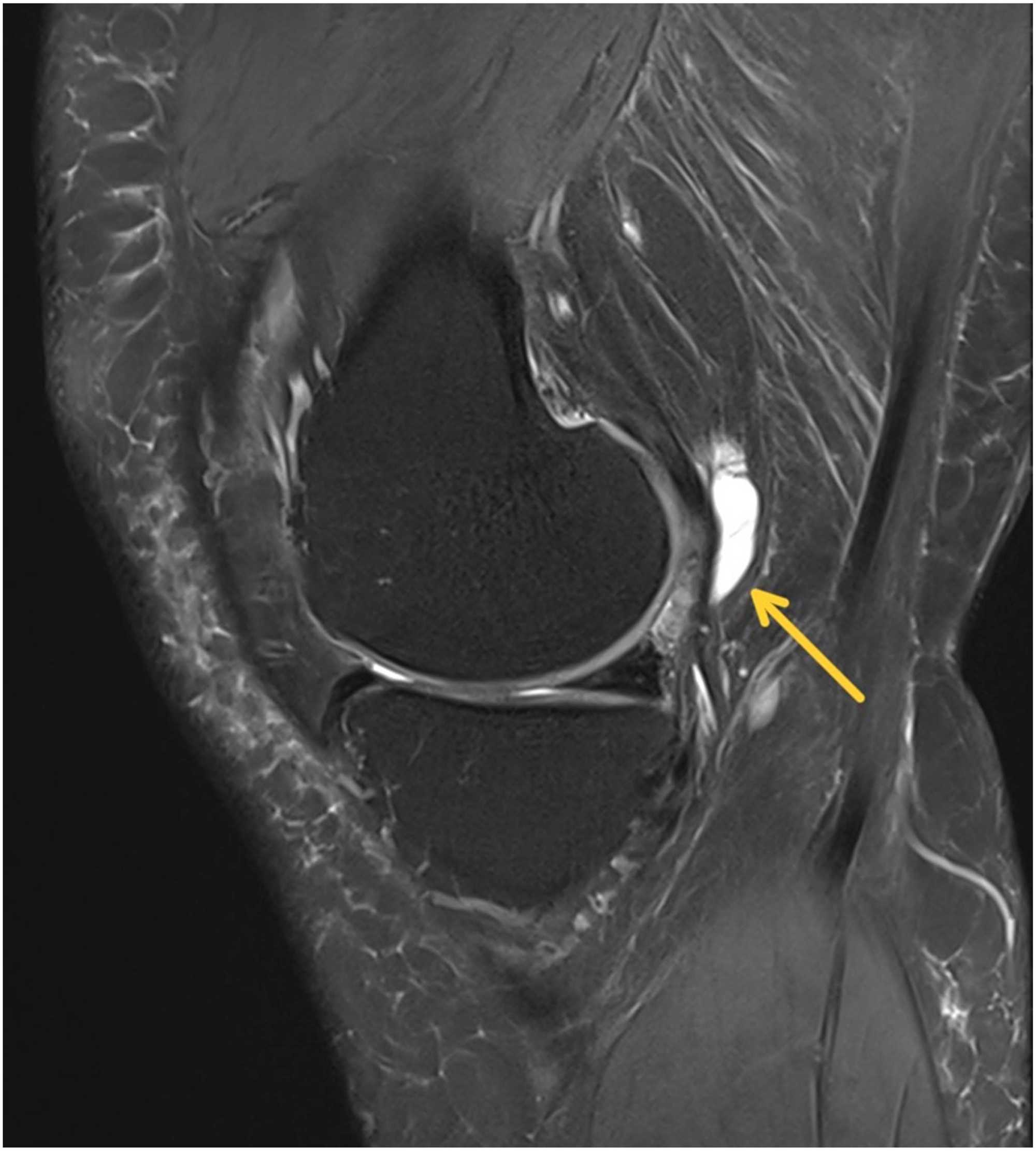 Loose Body in the Knee Joint: A Case Report