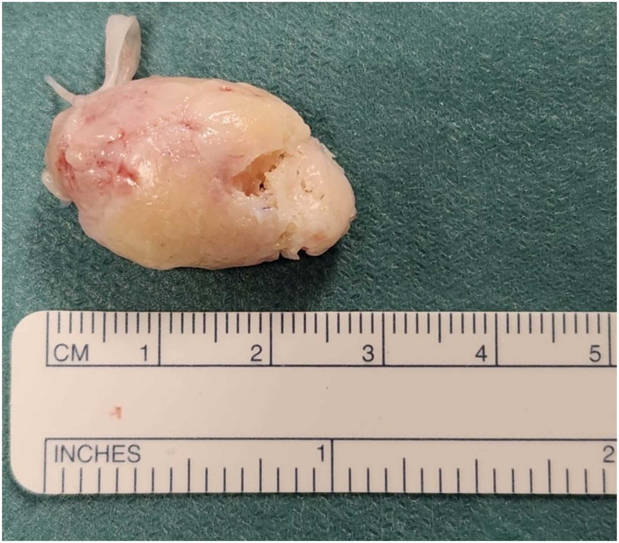 Loose Body in the Knee Joint: A Case Report