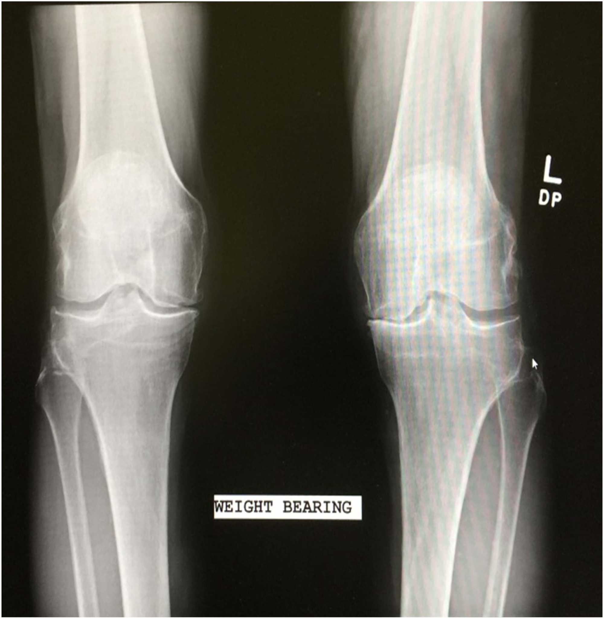 Ozone Injections in Orthopaedics: An Effective Substitute for Cortisone ...