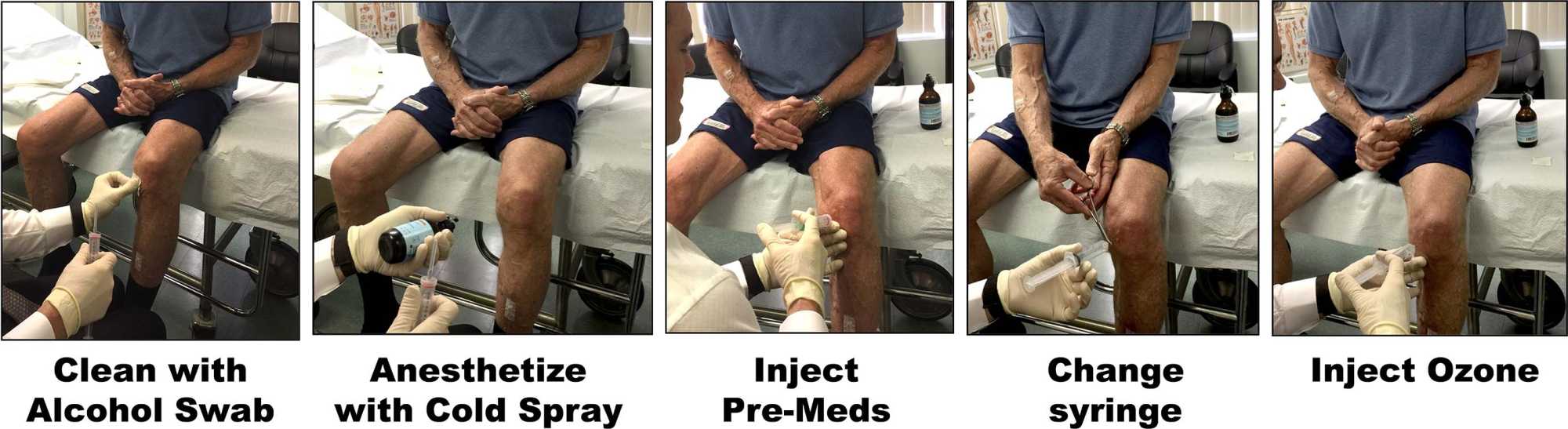 Ozone Injections in Orthopaedics: An Effective Substitute for Cortisone ...