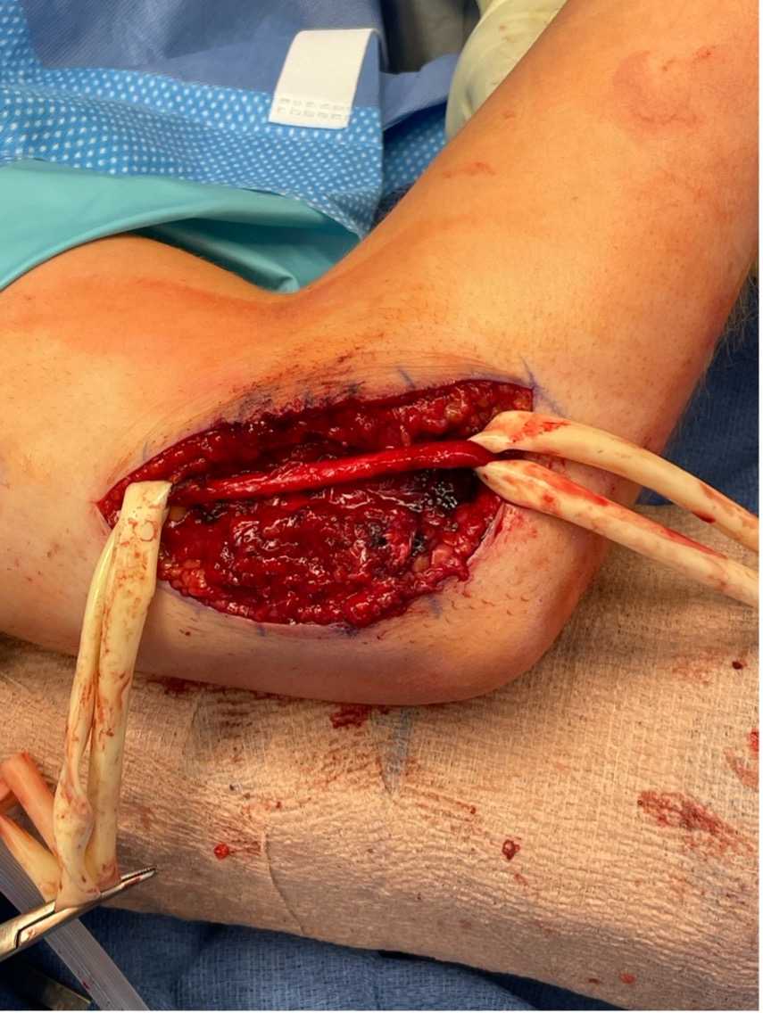 Missed Diagnosis of Snapping Triceps Syndrome: An Overlooked Cause of ...