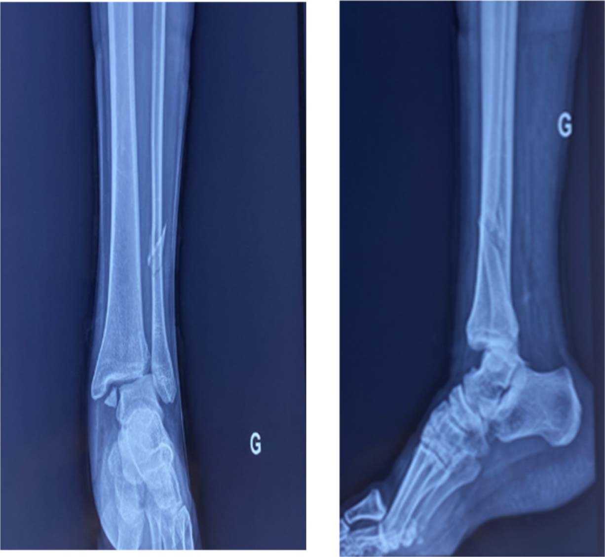 Bimalleolar Fractures: Management and Evaluation of Treatment ...