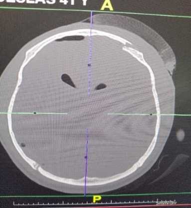 Contribution of Computed Tomography in the Diagnosis of ...