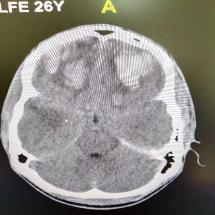 Contribution of Computed Tomography in the Diagnosis of ...