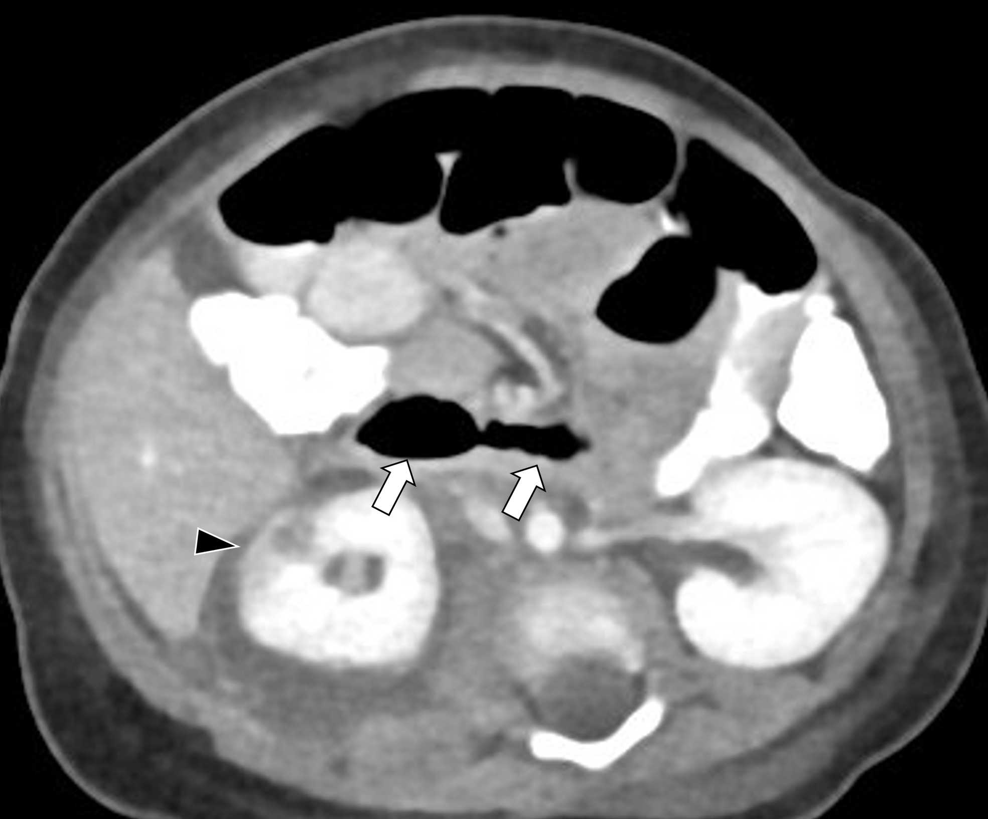 Utility of Computed Tomography for Evaluation of Normal Small Bowel ...