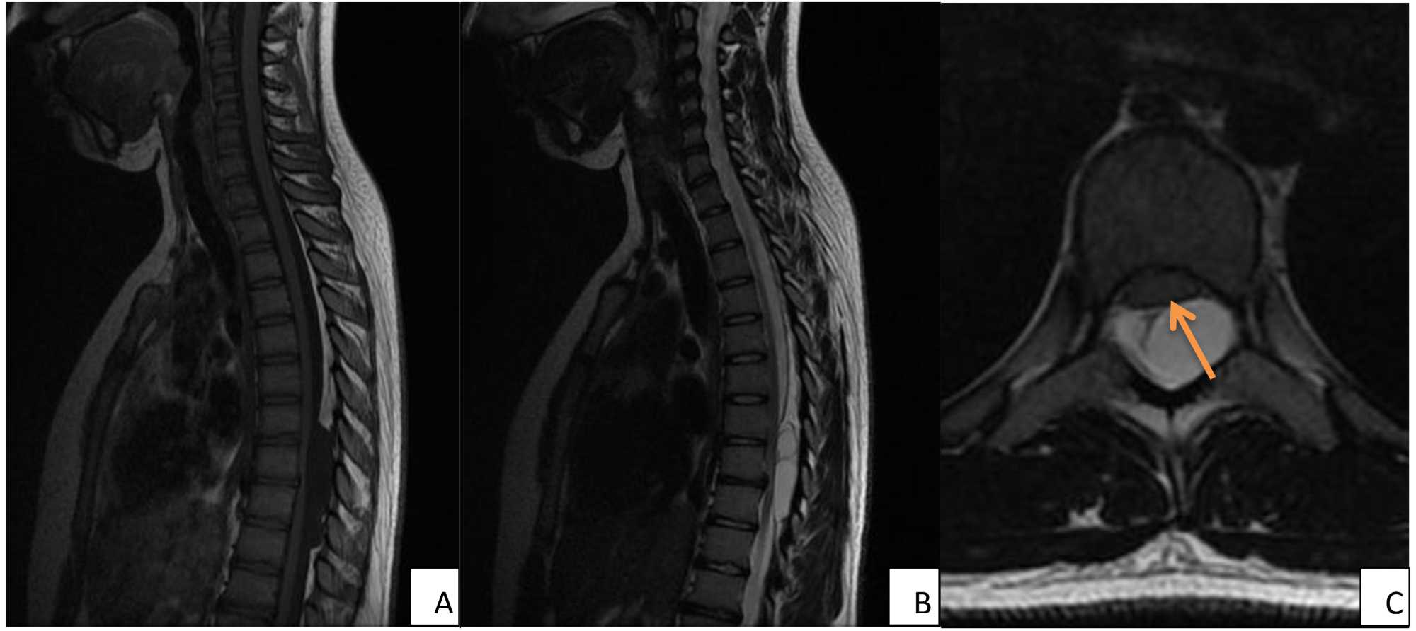 Spinal Extradural Arachnoid Cyst about a Case and Review of the Literature