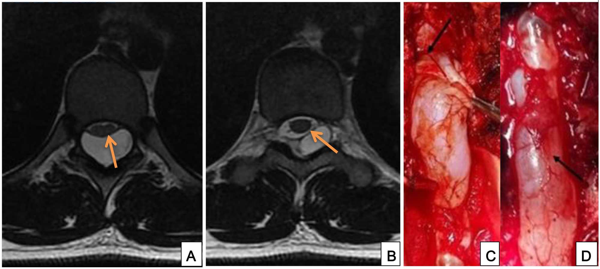 Spinal Extradural Arachnoid Cyst about a Case and Review of the Literature